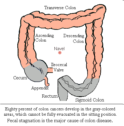 blog-o-blog: ca Colon / Kanker Usus Besar