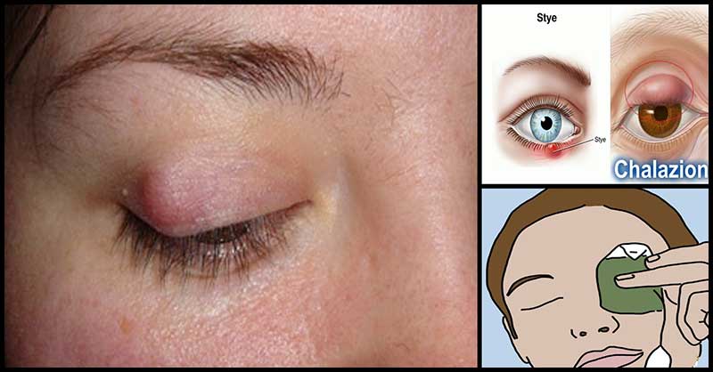 Home Remedies And Effective Treatments For Chalazion | Dr Farrah MD