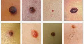 What is a Skin Mole and What Are the Main Characteristics of This Skin ...