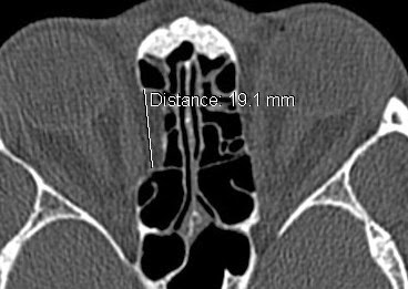 RADIODIAGNOSIS - IMAGE COLLECTION: Focal dehiscnece of lamina papyracea