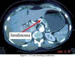 SABER DE SALUD: INSULINOMA
