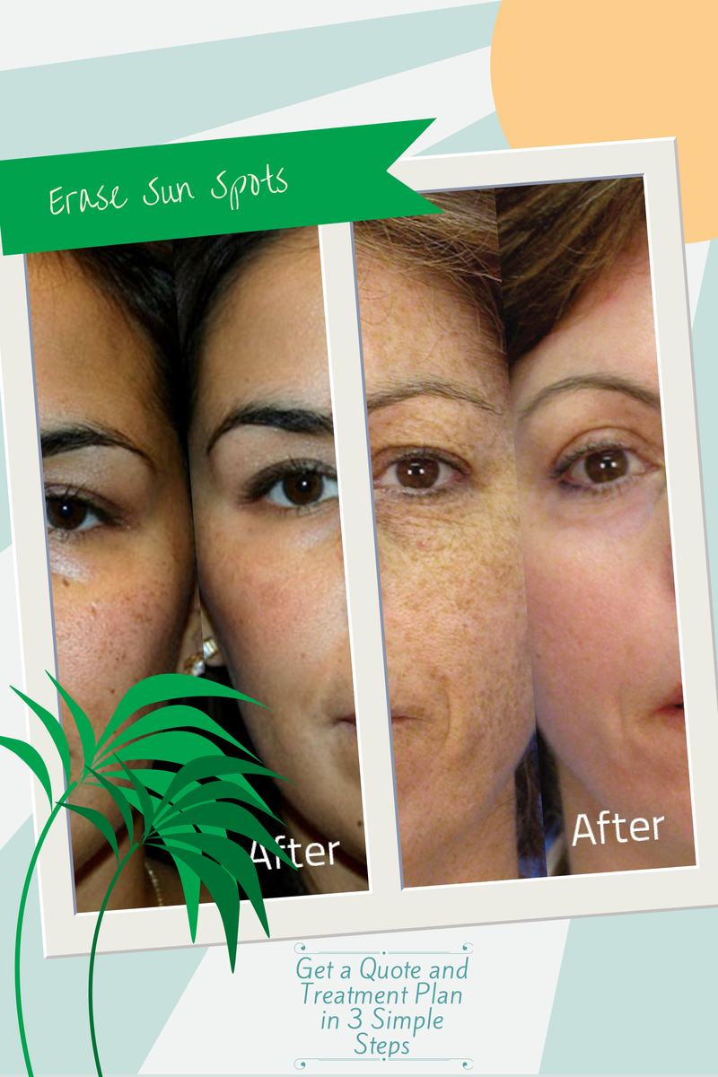 Erase Tattoo Removal: The Key to Younger Looking Skin: Removing Age Spots