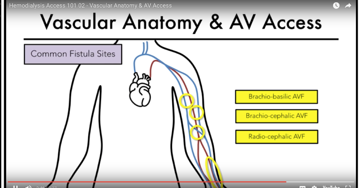 3 Types Of Vascular Access Ports Used In Hemodialysis