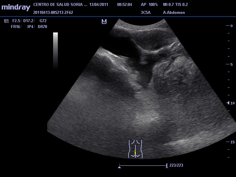 Ultrasonido Extrofia Vesical