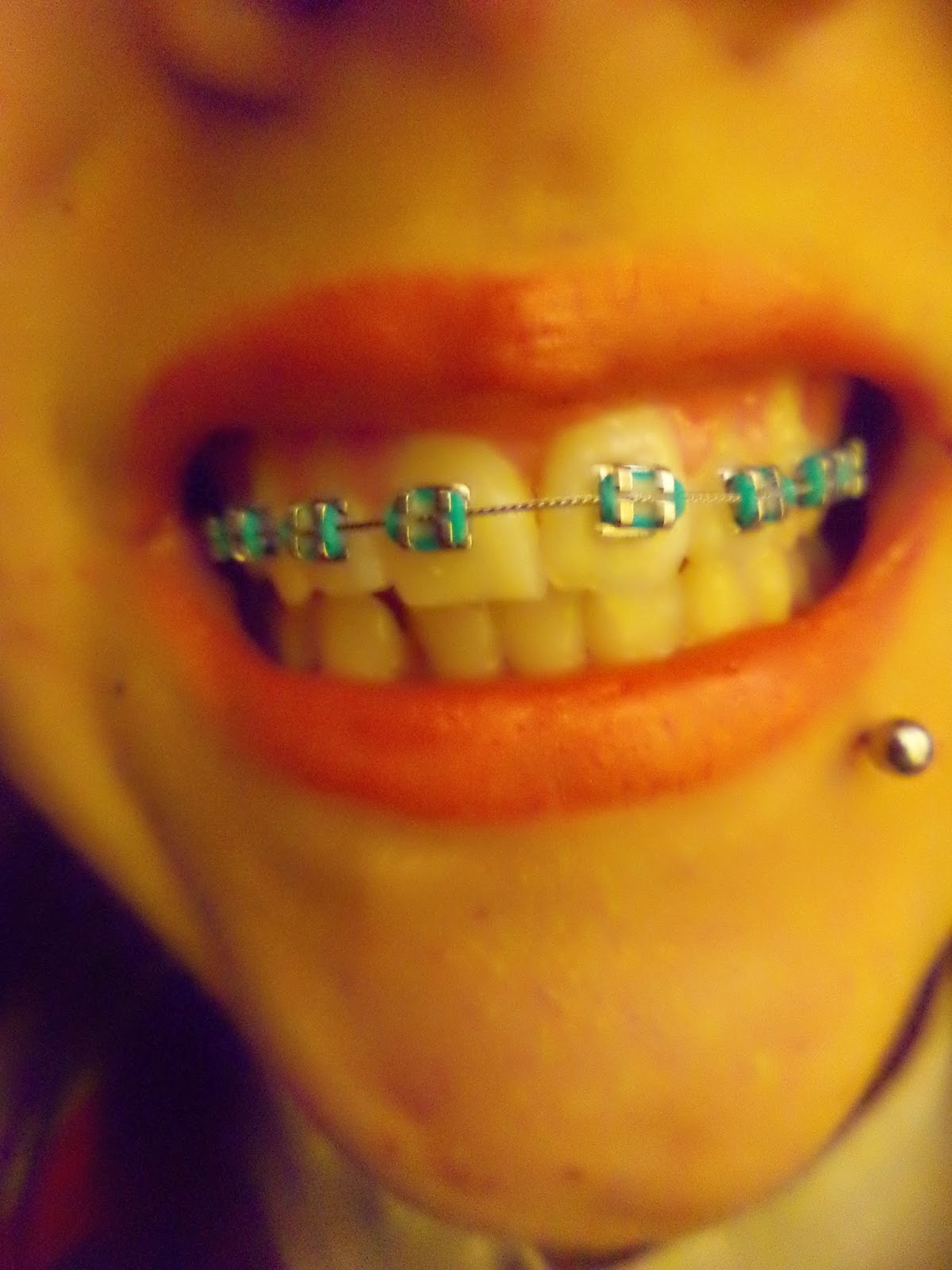 Mis Brackets: Paso a Paso [Mi experiencia]: 06/MAYO/2014 - CAMBIO DE LIGAS