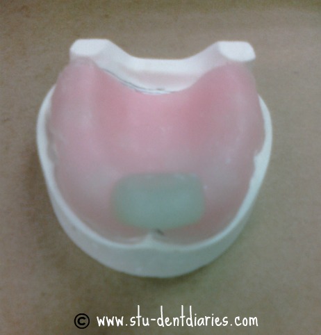 Stu-DENT Diaries: Custom Tray, Record Base and Wax Rim