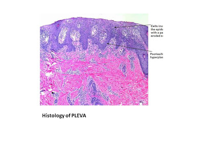 Consultations in Dermatology: Pityriasis Lichenoides PLEVA