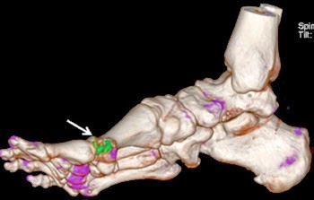 Gout and DECT - Sumer's Radiology Blog