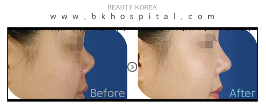 BK Plastic Surgery: [BK Plastic Surgery] Short Nose Extension/Upturned Nose Correction