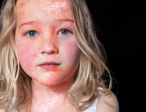 Scarlet Letters, dealing with vascular rosacea, face flushing, burning ...