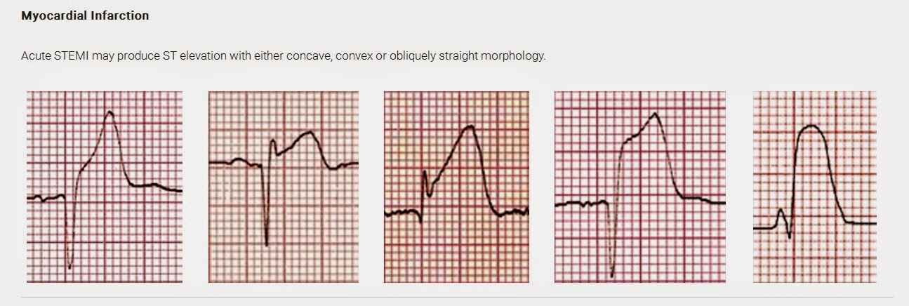 Segmen ST | INA - ECG