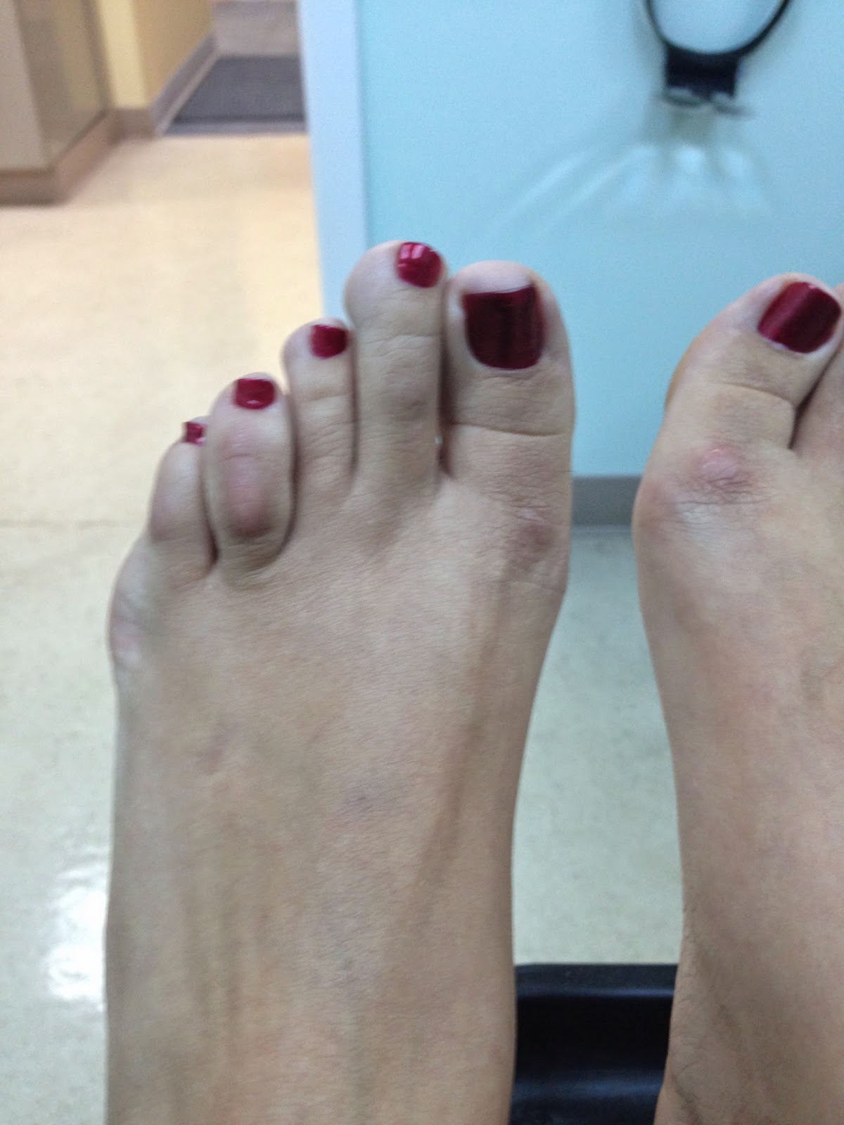 My Toe Shortening Surgery Experience : First Toe, Left Foot!
