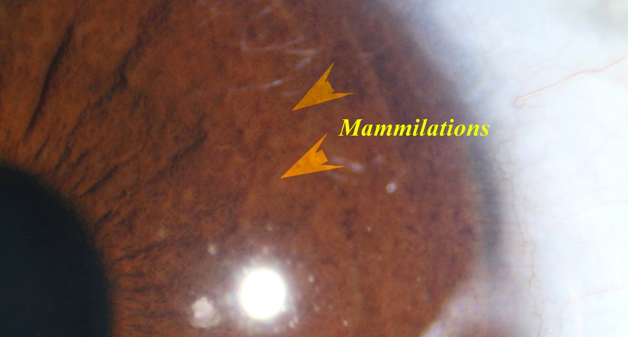 Modern & Multidimensional Iridology: Mammilations
