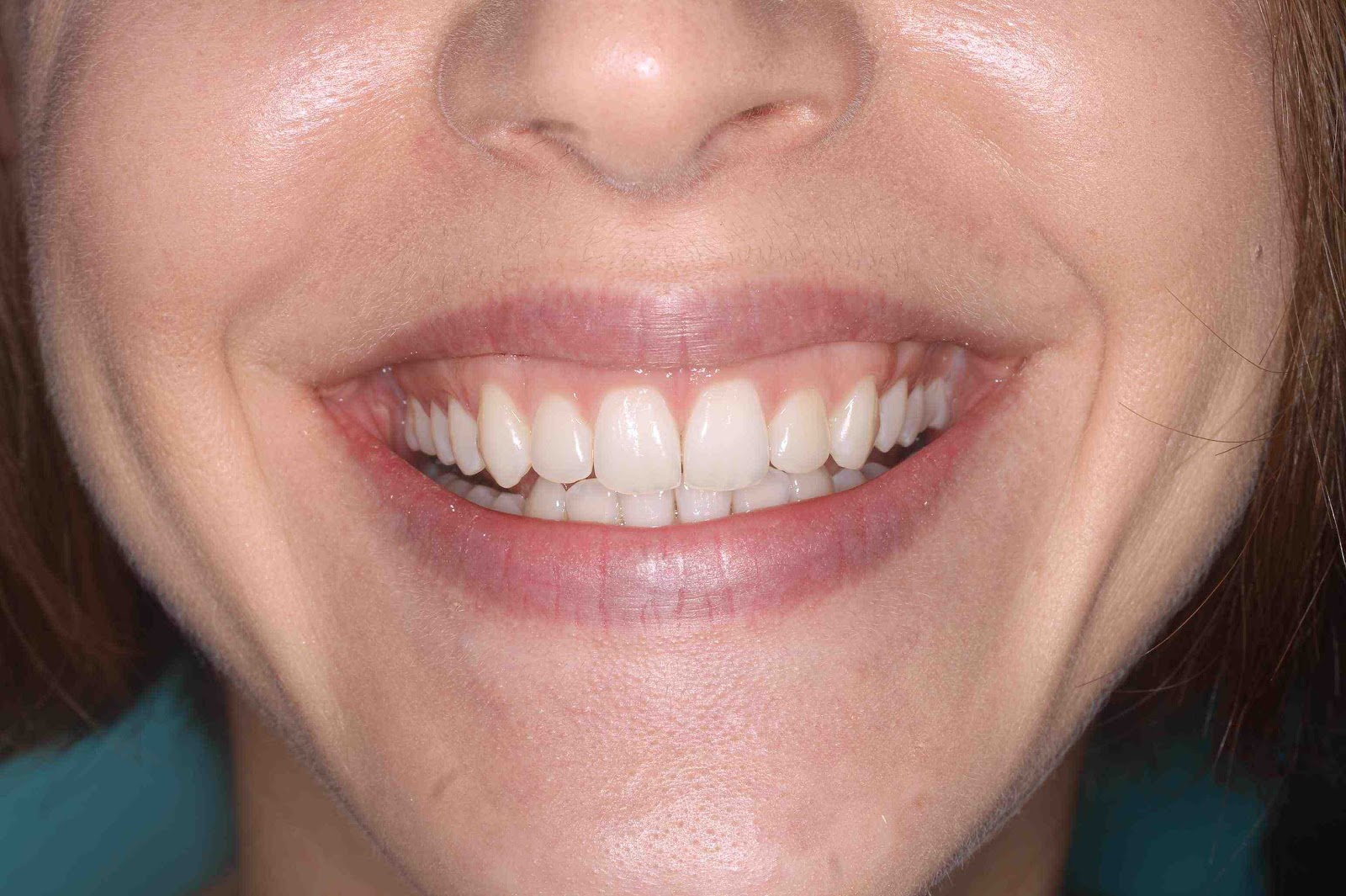 Richard Charon BDS: "Snaggle Teeth" to Lovely Smile with Invisalign®