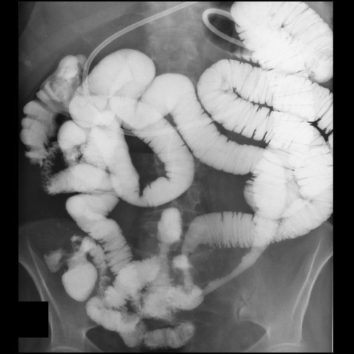 Hello USA: enteroclysis