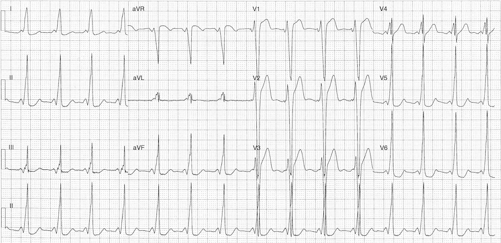 ECG of the Week: ECG of the Week - 28th December 2015