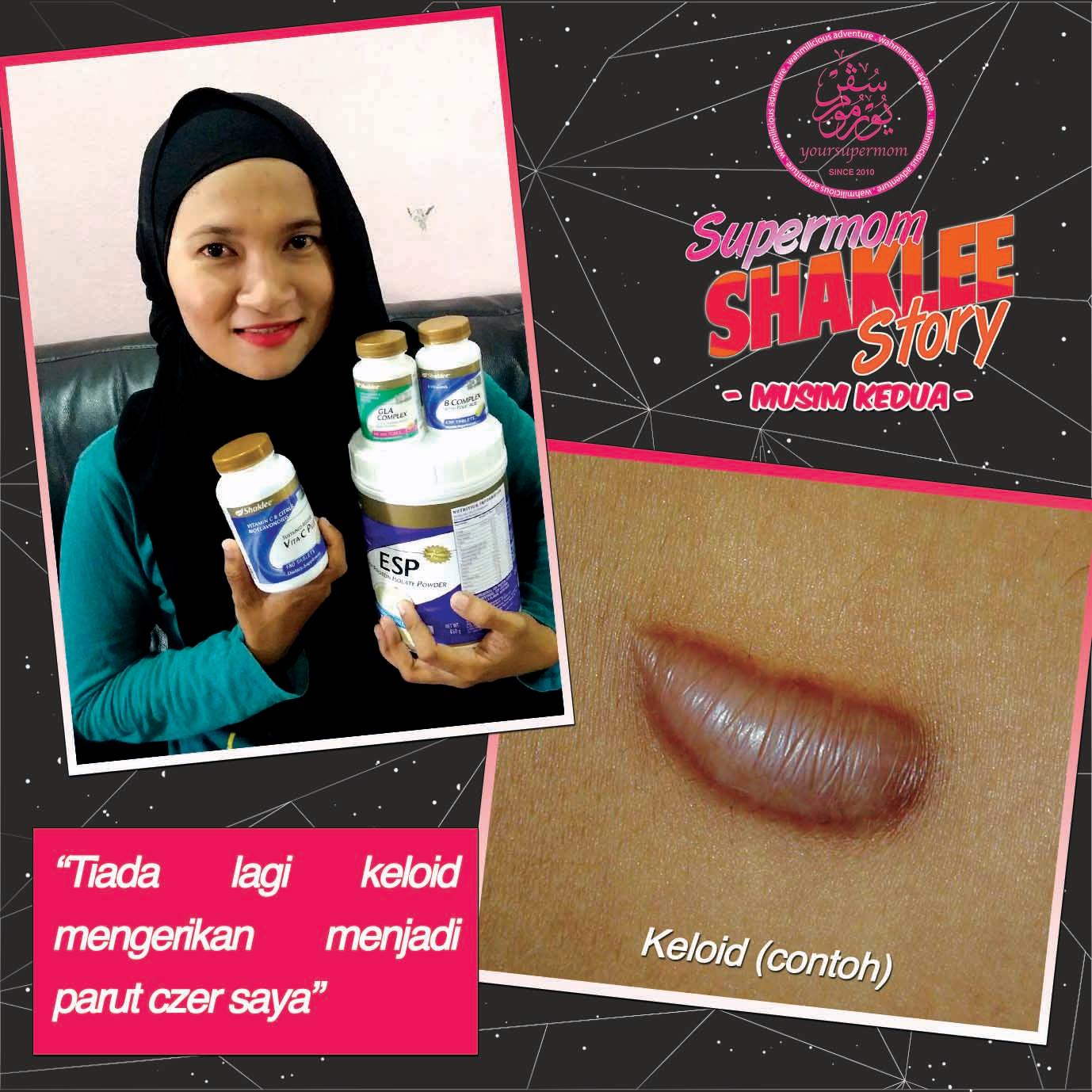 Parut Hidup (Keloid) Ceaser Hilang Secara Semulajadi | Umi Nazrah