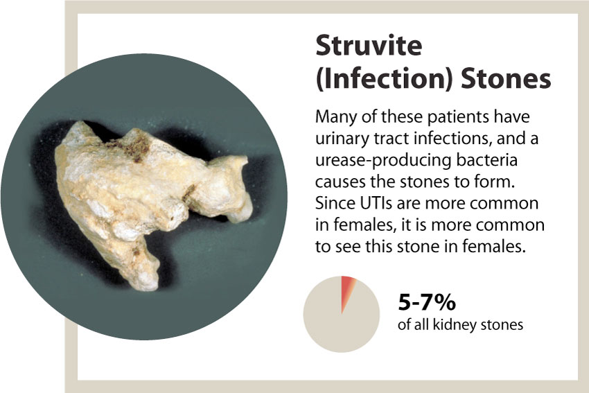 Nutrition science - easy learning: Kidney Stones