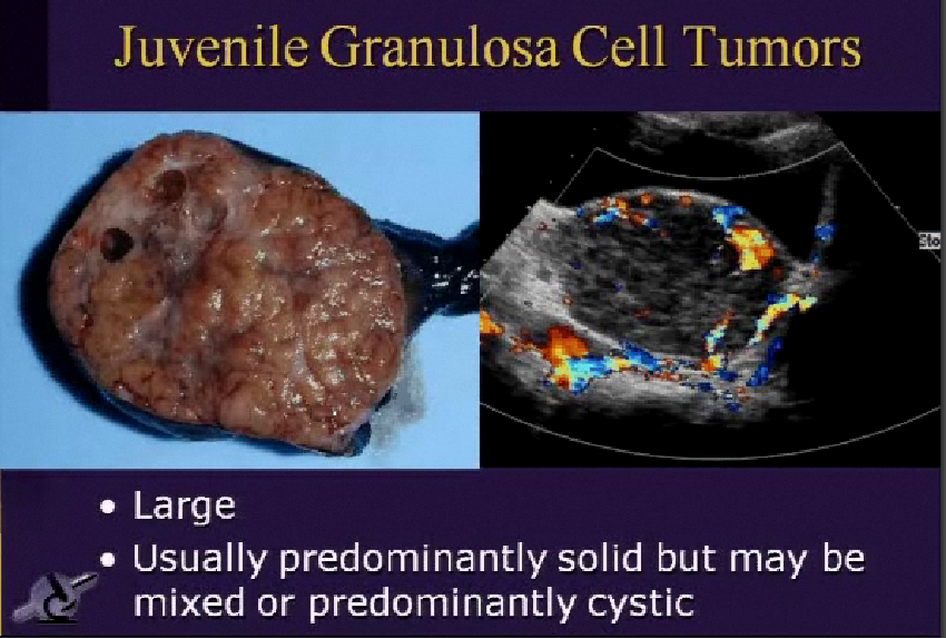 rsna: precocious puberty