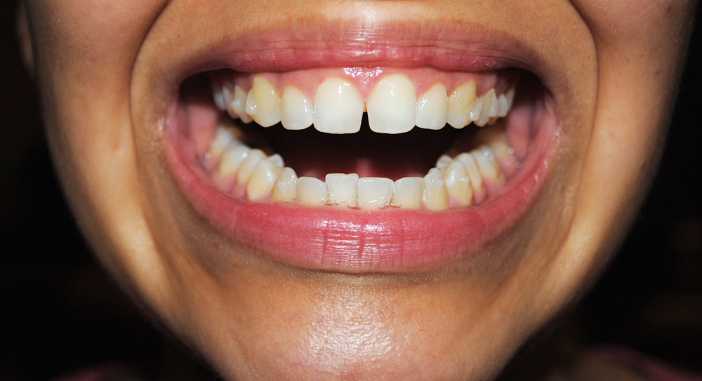My Life with Invisalign