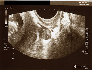 Medicina Materno Fetal: Arterias Uterinas, Preeclampsia y RCIU
