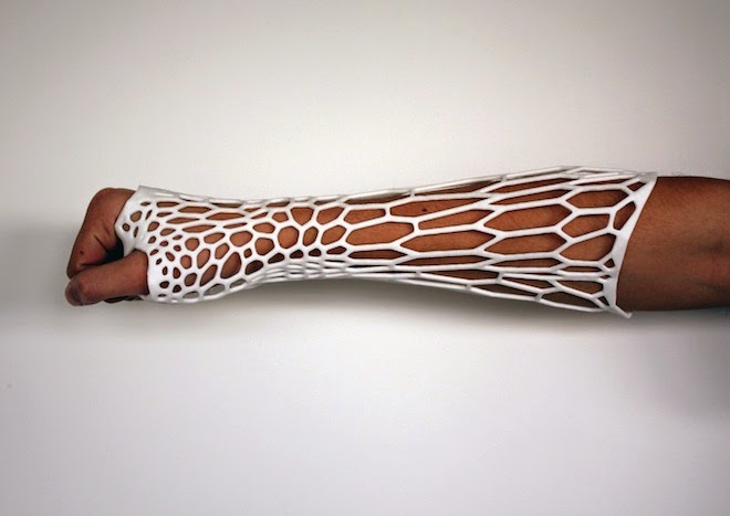 3D Printed Bone Fracture Plaster by Jake Evill ~ Shape Muse