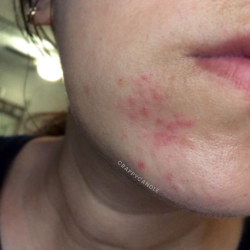 Mild Perioral Dermatitis Lips