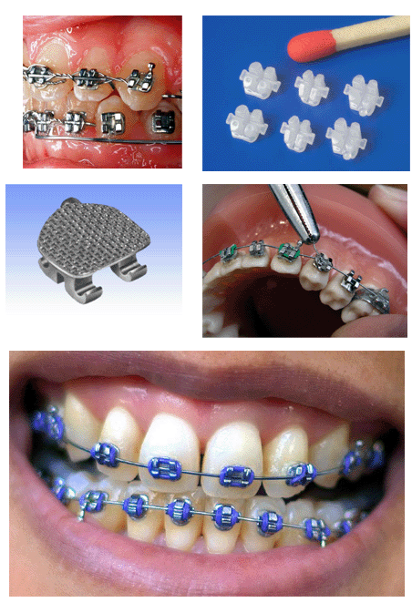 การจัดฟัน Orthodontic