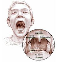 exudado faringeo: exudado faringeo