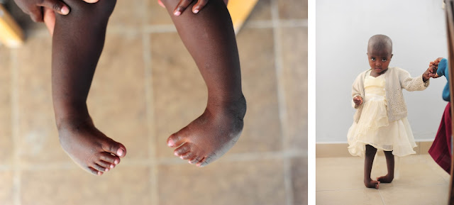 nick and suzanne: the Ponseti method