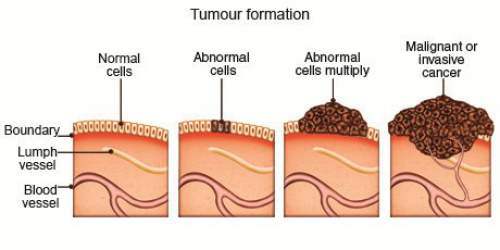 Apa Sebenarnya Arti Dari Stadium Kanker - Pasien Sehat