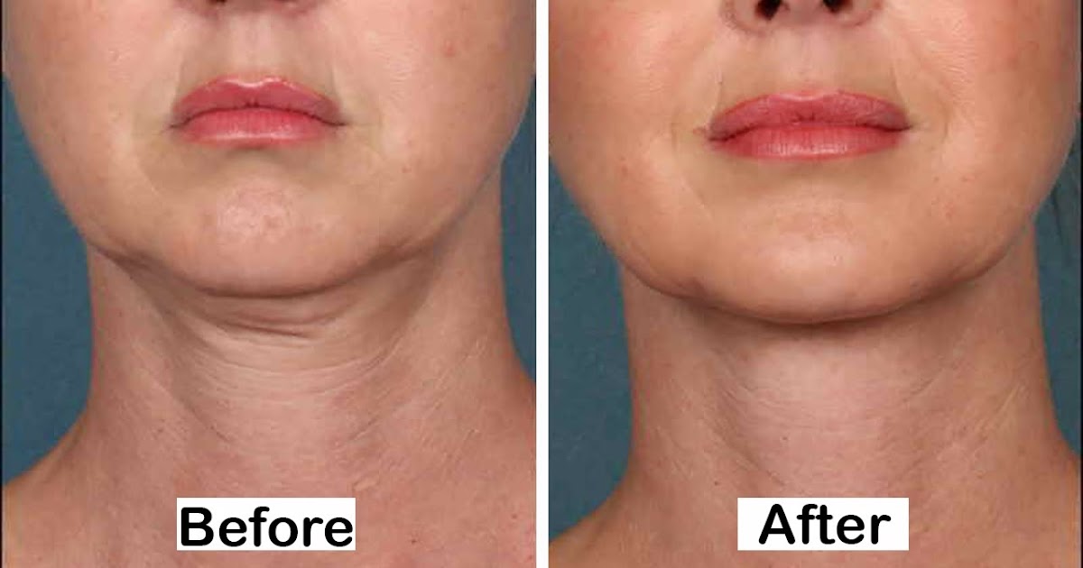 5 Simple Ways To Tighten Your Neck Skin
