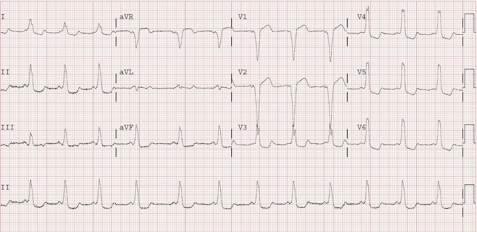 Dr. Smith's ECG Blog: WPW mimicking and obscuring acute MI