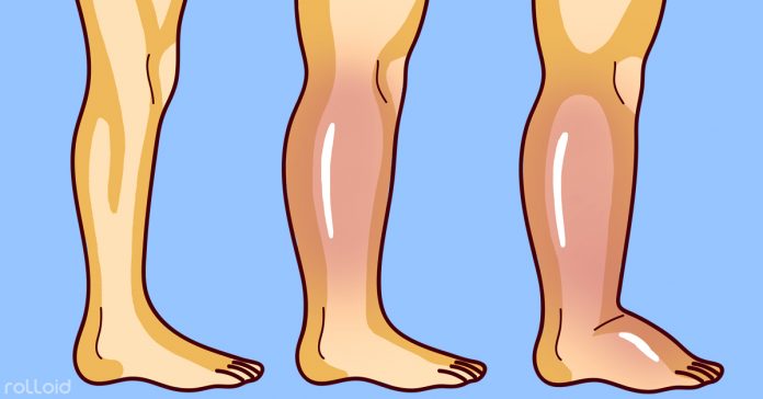 Pour combattre la rétention d'eau et l'enflure dans les jambes, essayer ...