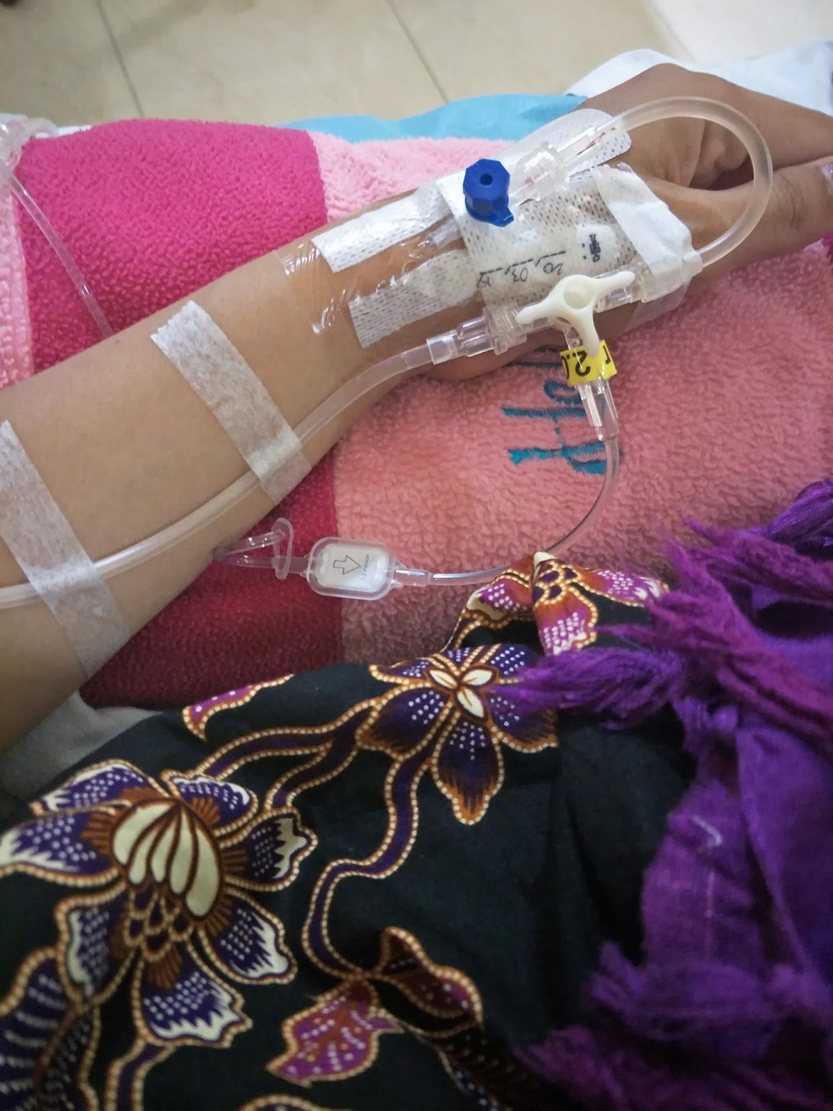 Pengalaman Menggunakan Laparoskopi pada Kasus Usus Buntu Kronik ... Pengalaman Menggunakan Laparoskopi pada Kasus Usus Buntu Kronik ...
