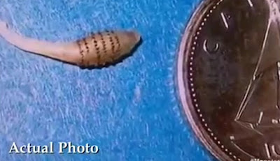 Maggots in the human flesh because of a mosquito bite. - Symptoms and ...