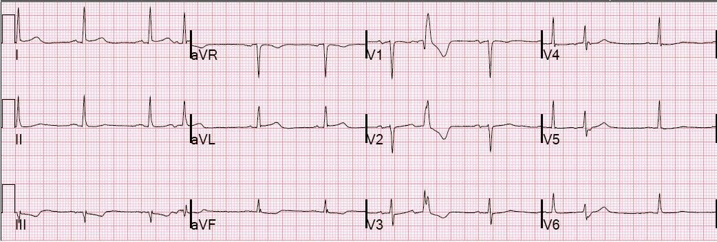 Inferior St Depression Ekg