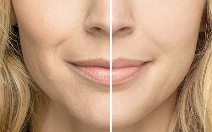 Dermal Filler Injections To Correct Smile Lines And Laugh Lines