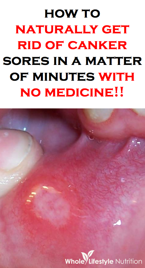 How To Naturally Get Rid Of Canker Sores In Minutes With No Medicine