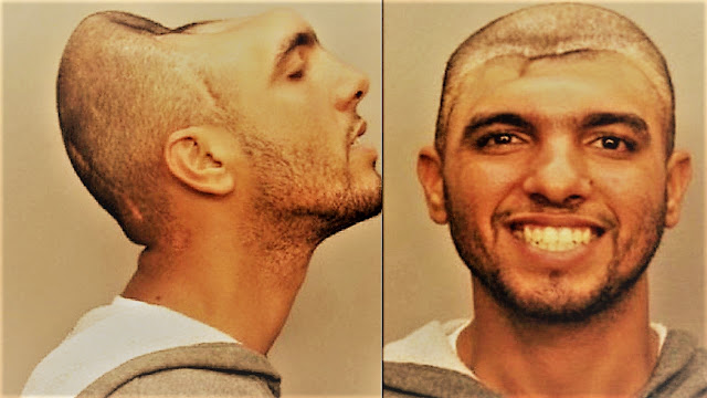 5 Insane Plastic Surgeries You Have Never Seen Before!!! - Vijay's Blog