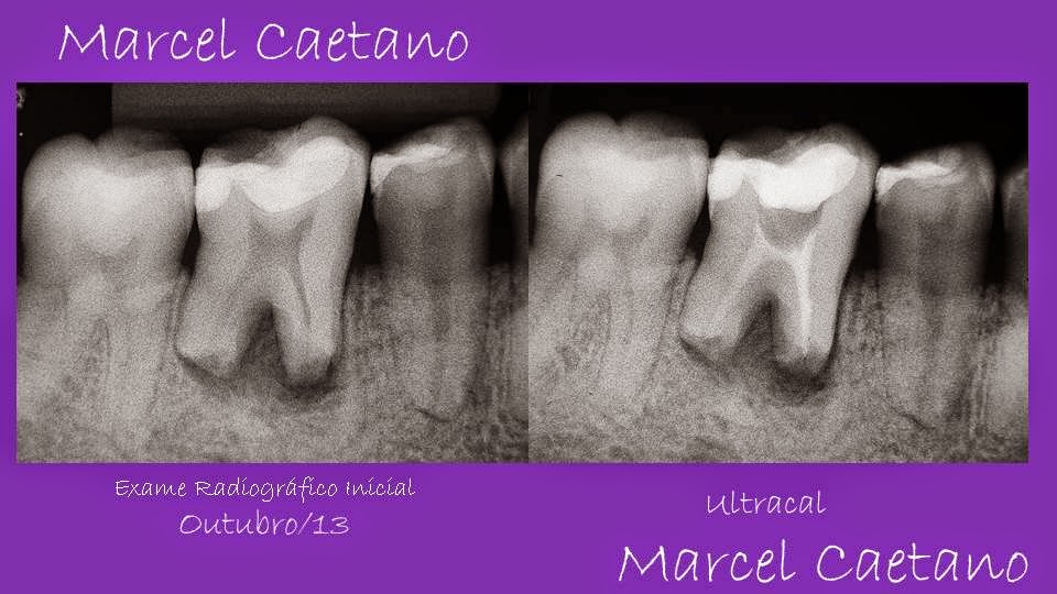 Endodontia Avançada: Reabsorções Radiculares pós-tratamento ortodôntico.