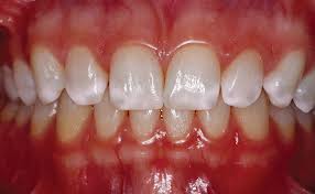 Ortodontia é Arte: O que é fluorose?