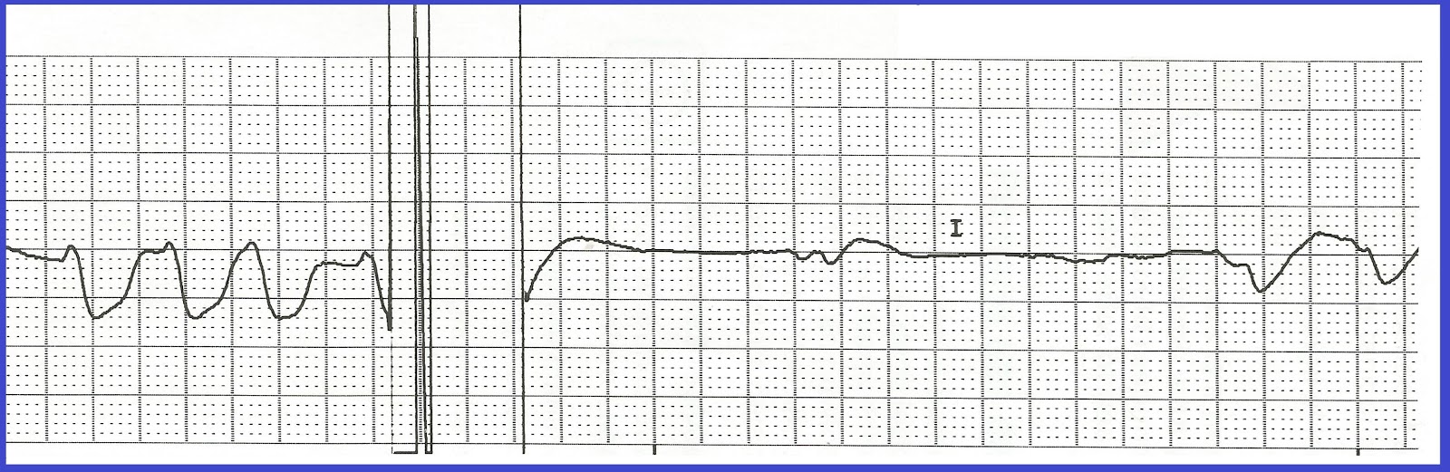Code Blue: Cardiac arrest