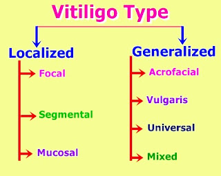 Vitiligo Types: How Many Types of Leucoderma Vitiligo? | Modern Herbalife
