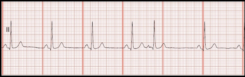 EKG Rhythm Strip Quiz 133