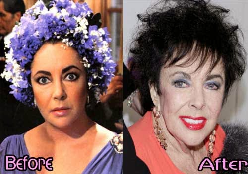 Did Elizabeth Taylor Get Plastic Surgery Facelift, Botox Injection ...