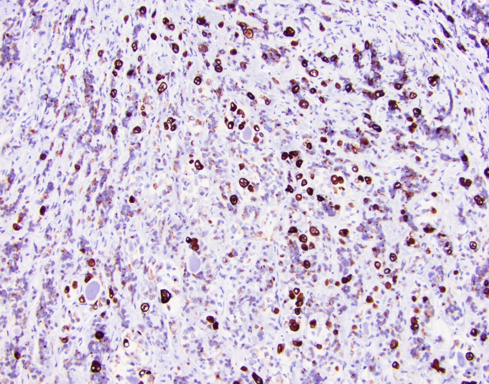 neuropathology blog: Crooke cell change in a normal pituitary of a ...