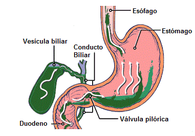 Dr.Tormo - Reflujo gastroesofágico; nuevos tratamientos; reflujo y ejercicio; reflujo biliar