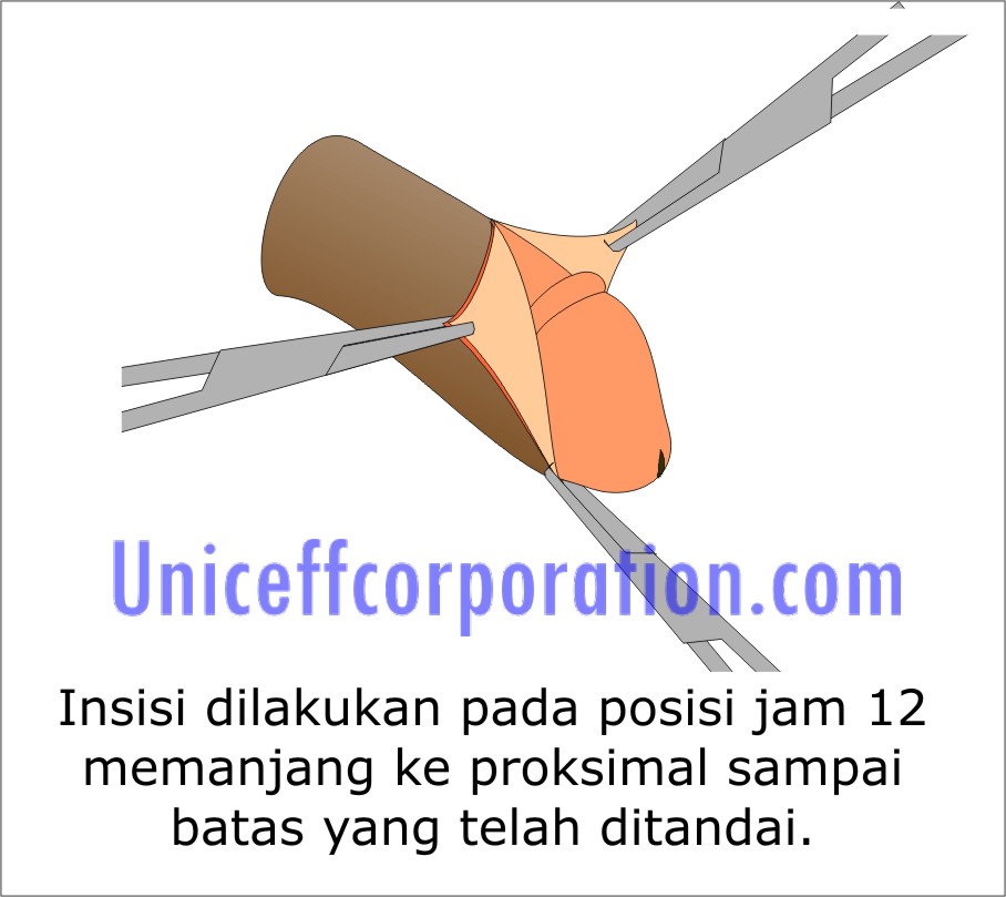 Kelebihan Berkhatan ~ I Luv Info