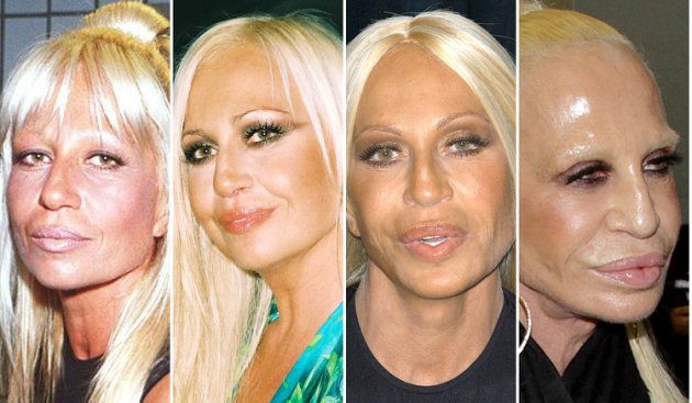 Donatella Versace Bad Plastic Surgery | Celebrity Bad Plastics Surgery